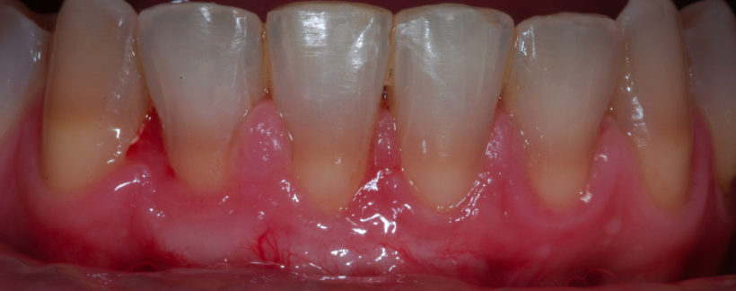 ¿Cuáles son las causas de los dientes sensibles? | Dentista Talavera